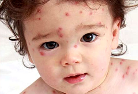 Catapora e Varicela – Sou Doutor Cevac